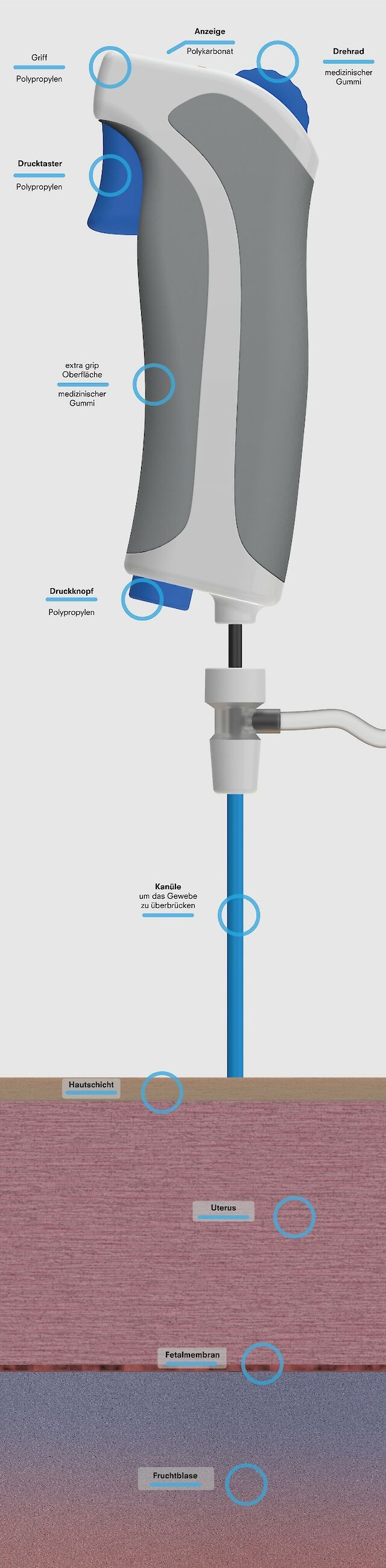 AmnioFix - Verschliessen der Fetalmembran – Industrial Design ZHdK