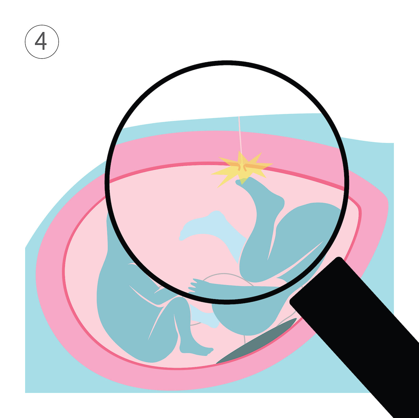 AmnioFix - Verschliessen der Fetalmembran – Industrial Design ZHdK